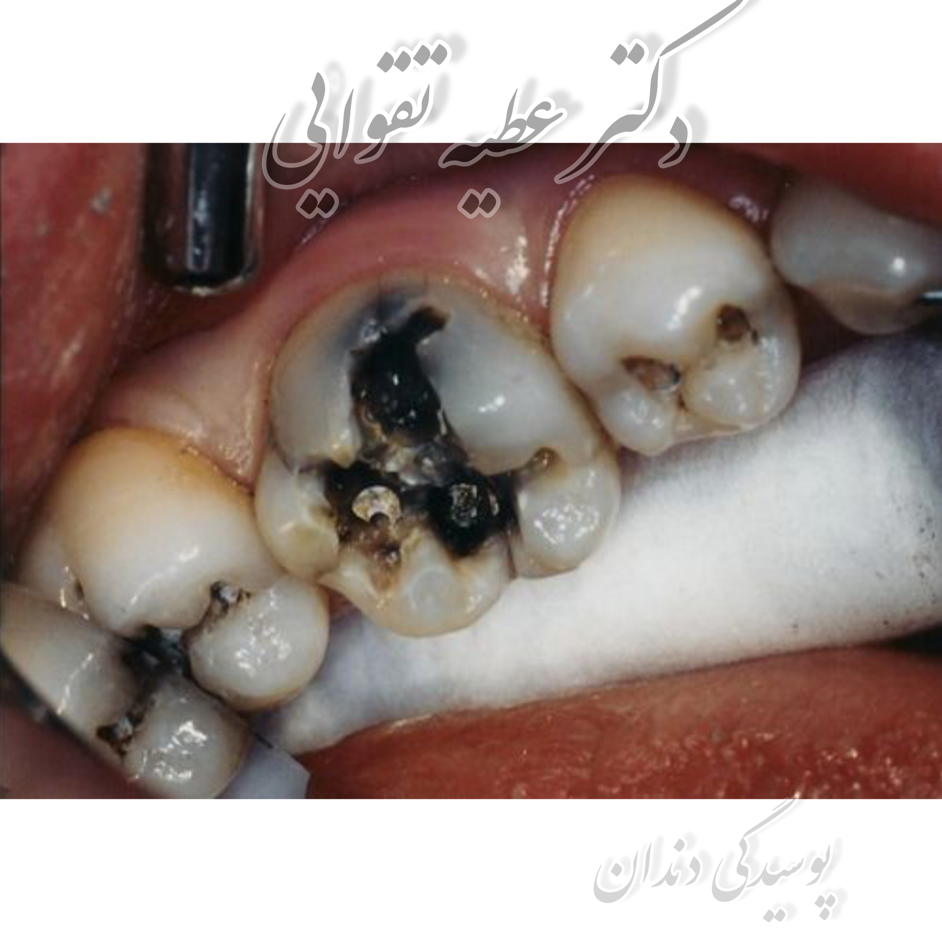 علت پوسیدگی دندان چیست؟ درمان پوسیدگی دندان خانم دکتر عطیه تقوایی